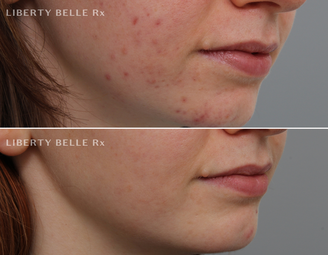 SKINCARE BEFORE & AFTER RESULTS | Liberty Belle Rx by Dr Chris Moss